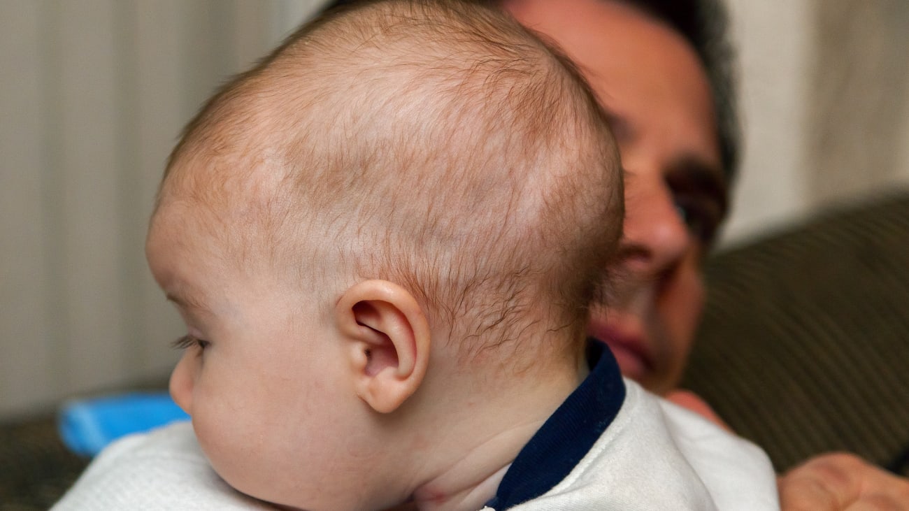 coronal ridge newborn
