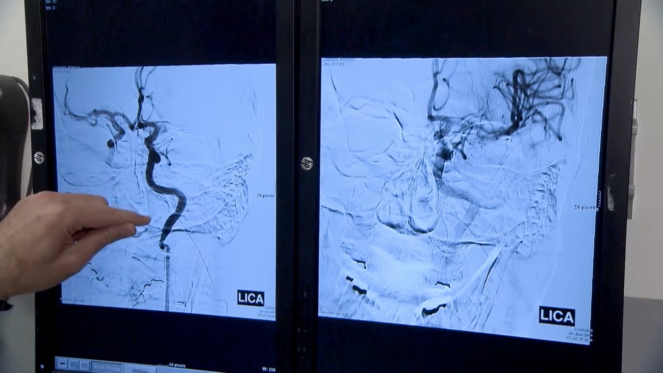 Comprehensive Stroke Center - UW Medicine Provider Resource Comprehensive Stroke Center - UW Medicine Provider Resource