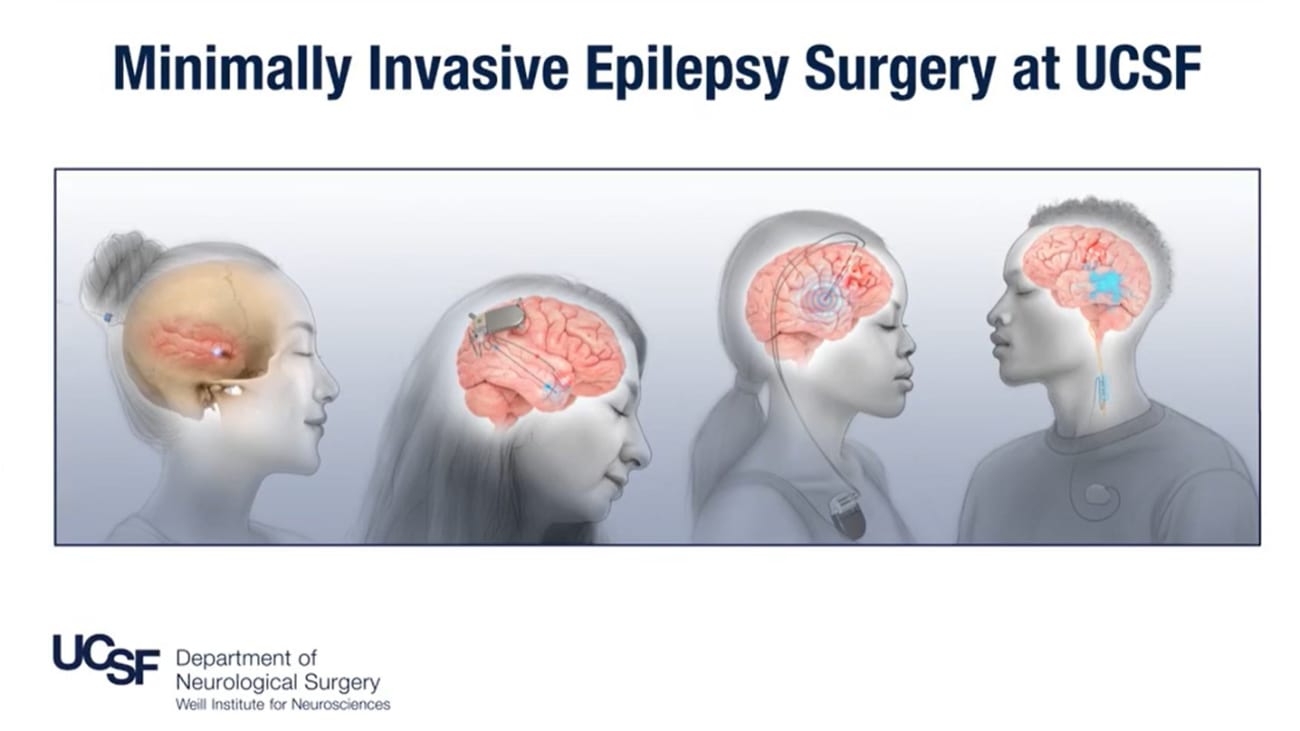 Surgery For Epilepsy Advanced Techniques And Appropriate Candidates Surgery For Epilepsy Advanced Techniques And Appropriate Candidates