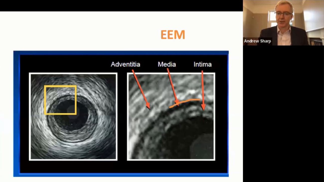 Key Measurement And Vessel Sizing Techniques For Utilizing Ivus In Routine And Complex Cases