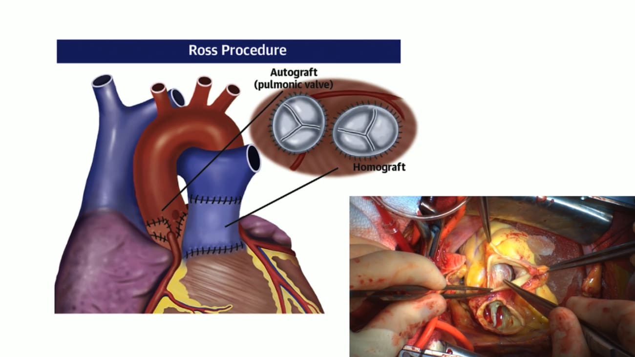Ross Procedure for Aortic Valve Disease: Why It's the Superior Option in Younger Patients - UCSF ...