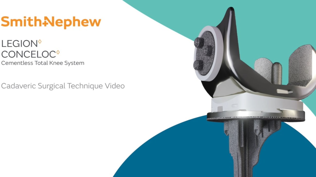 LEGION COCNELOC Cementless Total Knee System Smith Nephew LEGION COCNELOC Cementless Total Knee System Smith Nephew