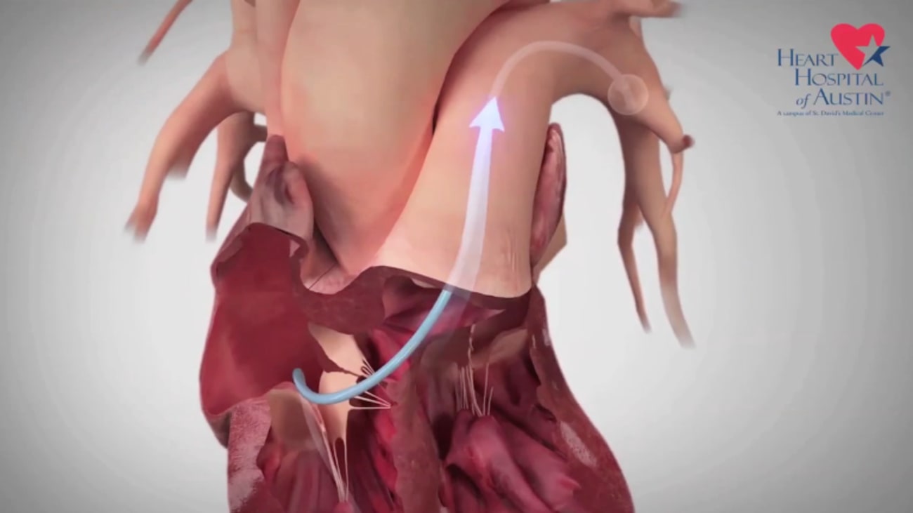 CardioMEMS: Treating Heart Failure Before the Onset of Symptoms ... CardioMEMS: Treating Heart Failure Before the Onset of Symptoms ...