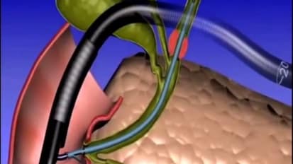 ercp procedure biliary stent