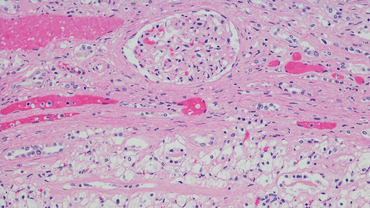 Renal Cell Carcinoma Research Sheds New Light On Advanced Disease Ucsf Medconnection