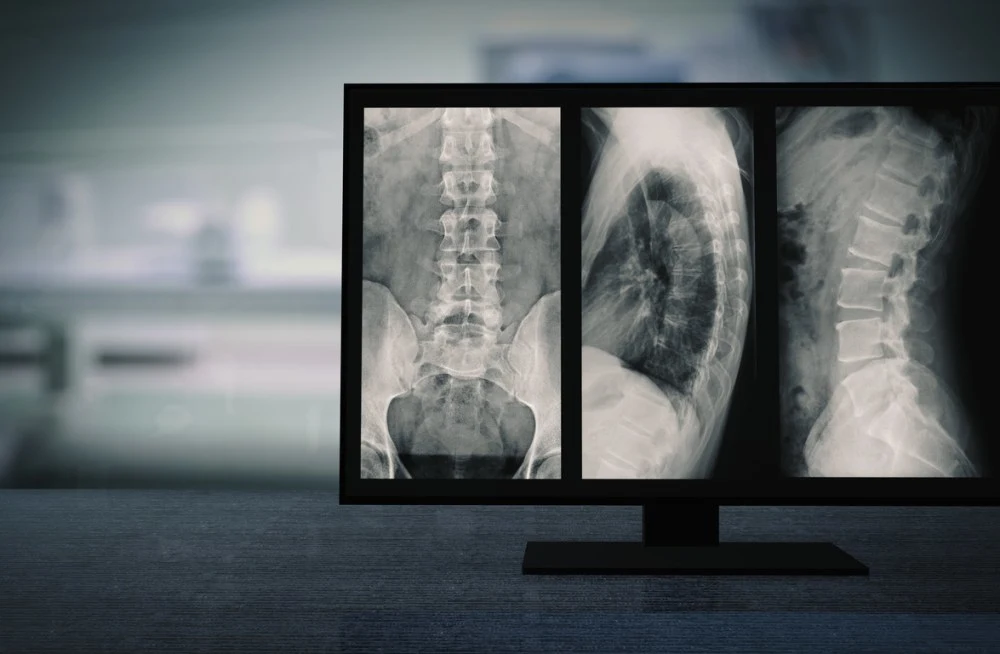 Machine Learning To Detect Missed Cervical Spine Fractures