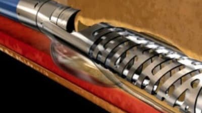 New Catheter Lets Doctors See Inside Arteries - Tech Briefs