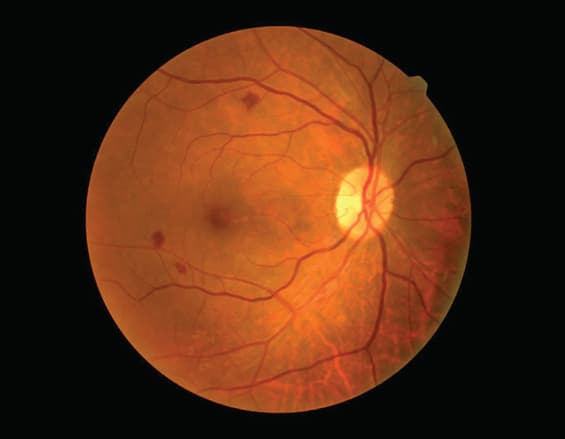 A New Generation of Artificial Retinas Based on 2D Materials - Medical ... A New Generation of Artificial Retinas Based on 2D Materials - Medical ...