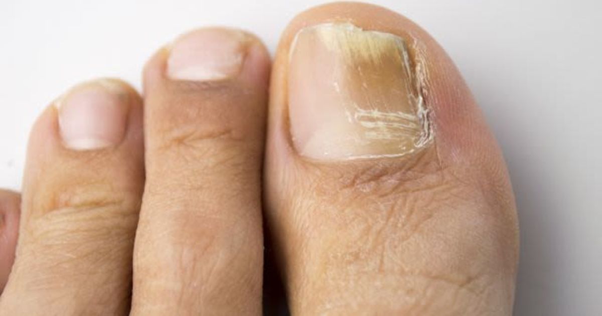 Behandling av Neglesopp med Laser: En Effektiv Løsning · TBL Medical