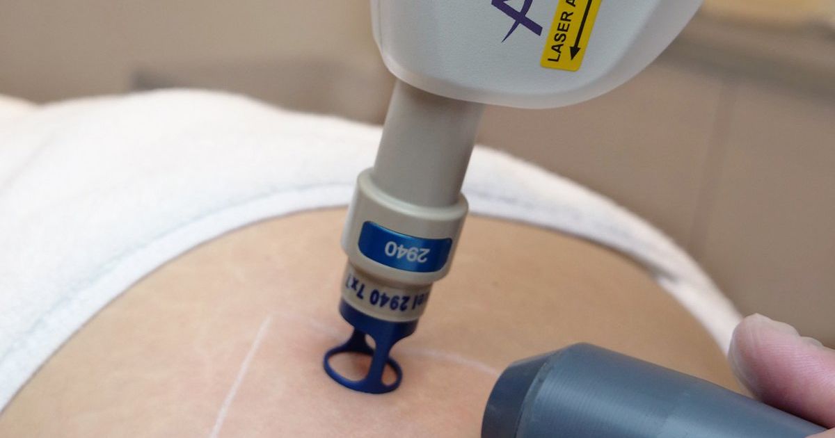 Laserbehandling · TBL Medical
