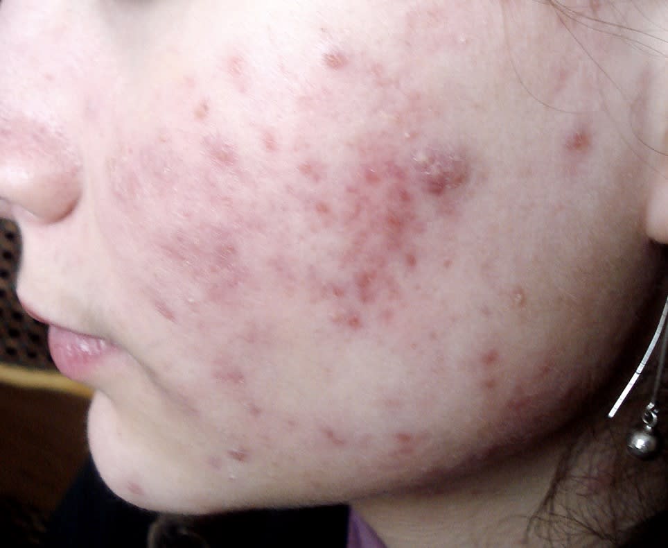 Accutane (Isotretinoin) Overview: Cost, Recovery, Before & After | AEDIT