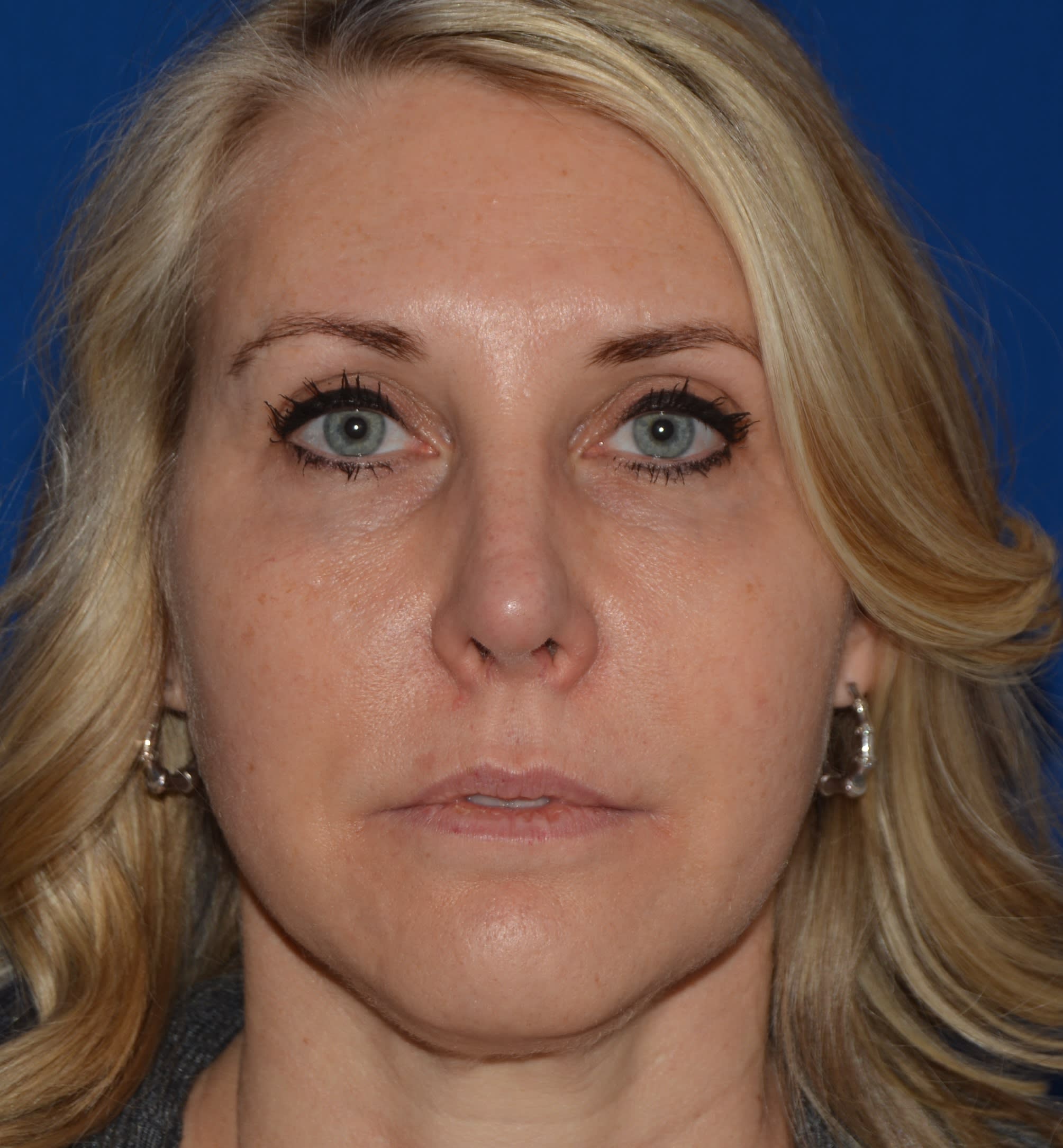 Dr. Samuel Hahn - Facial Plastic and Reconstructive Surgery - Provider ...