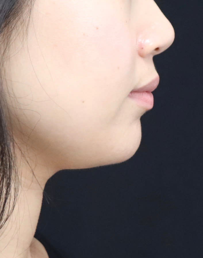 Chin Enhancement Solutions Overview: Cost, Recovery, Before & After | AEDIT