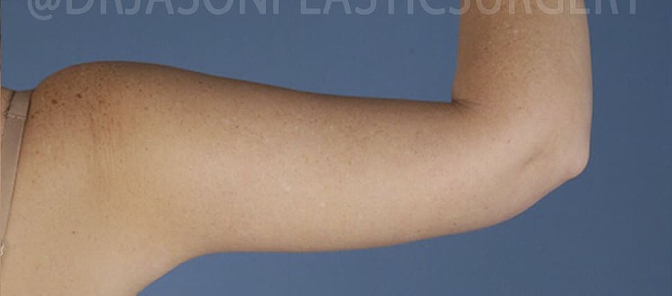 Arm Lift Overview: Cost, Recovery, Before & After | AEDIT