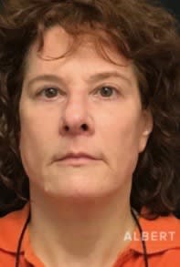 Subnasal 'Bullhorn' Lip Lift Overview: Cost, Recovery, Before & After ...