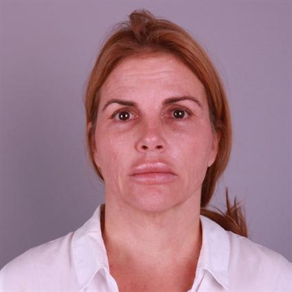 Brow Lift (Forehead Lift, Browplasty) Overview: Cost, Recovery, Before ...