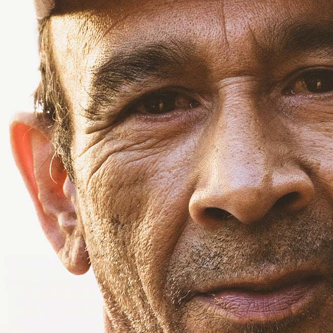 Lower Eyelid Blepharoplasty Subciliary Approach Overview: Cost ...