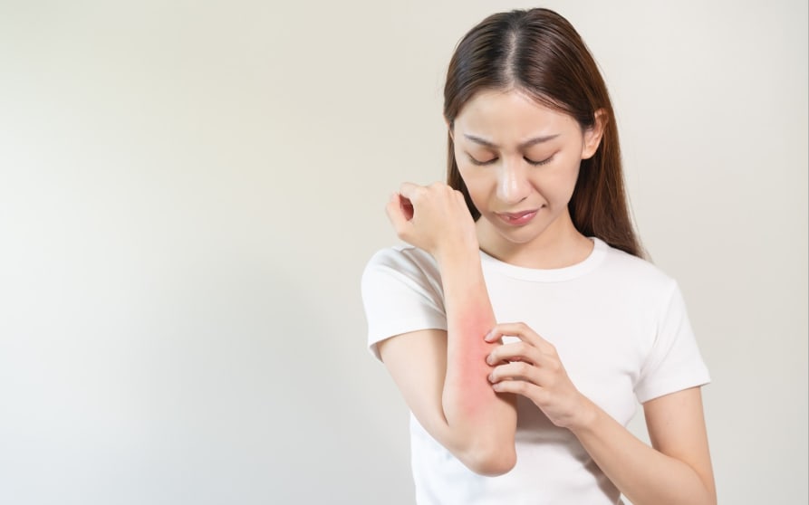 Urticaire de chaleur : causes et symptômes - Aroma-Zone