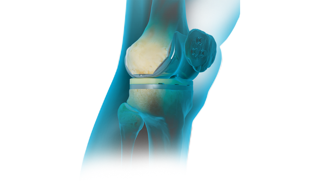 Arthrex - Arthroplasty Knee