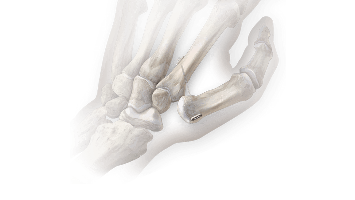 Arthrex - Hand and Wrist