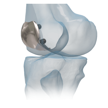 Arthrex - Arthroplasty Knee