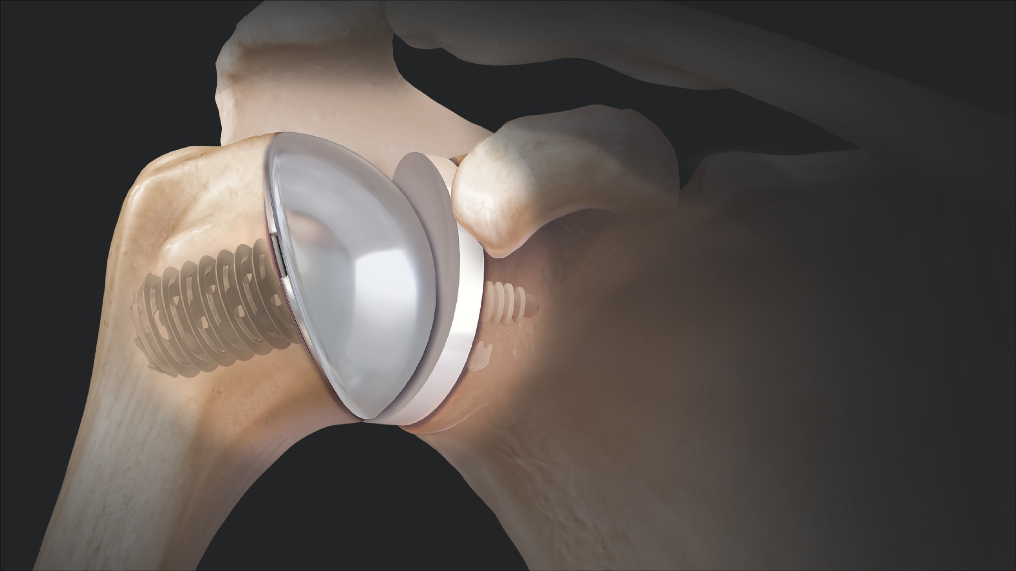 Arthrex - Total Shoulder Replacement Using Eclipse™ Total Shoulder ...