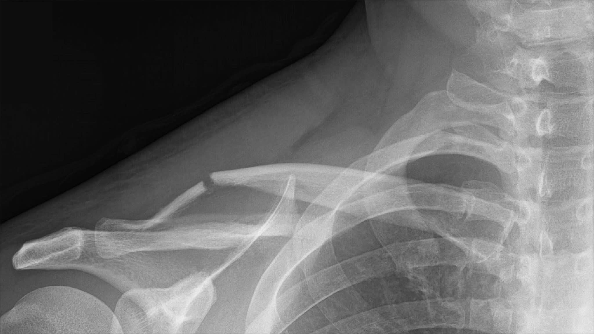 Arthrex - FiberTape® Cerclage