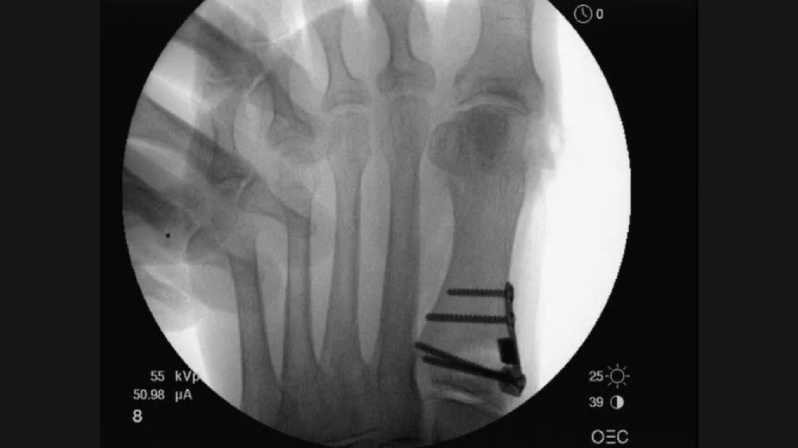 Arthrex - Proximal 1st Metatarsal Osteotomy Featuring the LPS Opening ...