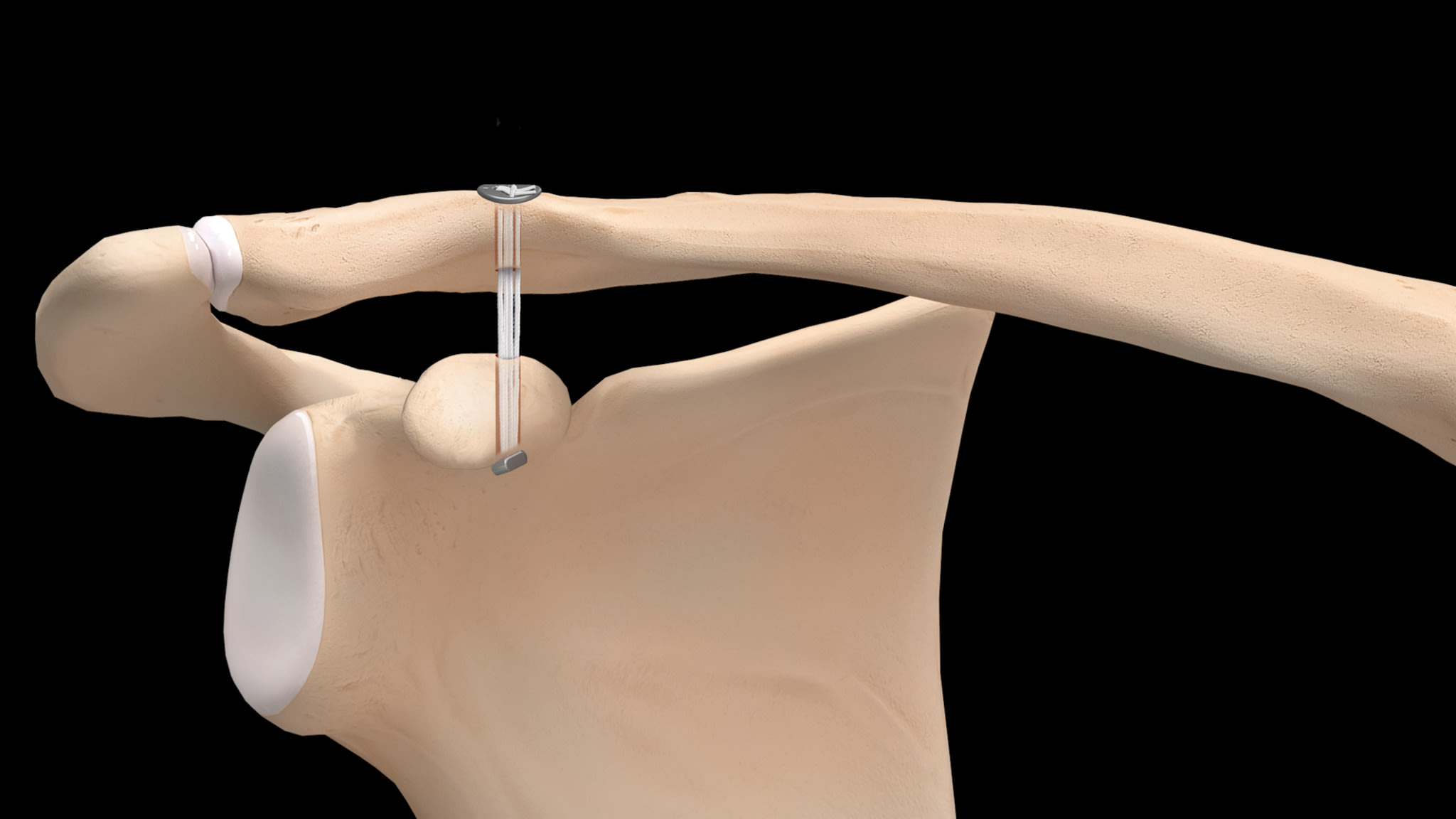 Arthrex Knotless Ac Tightrope® Repair System