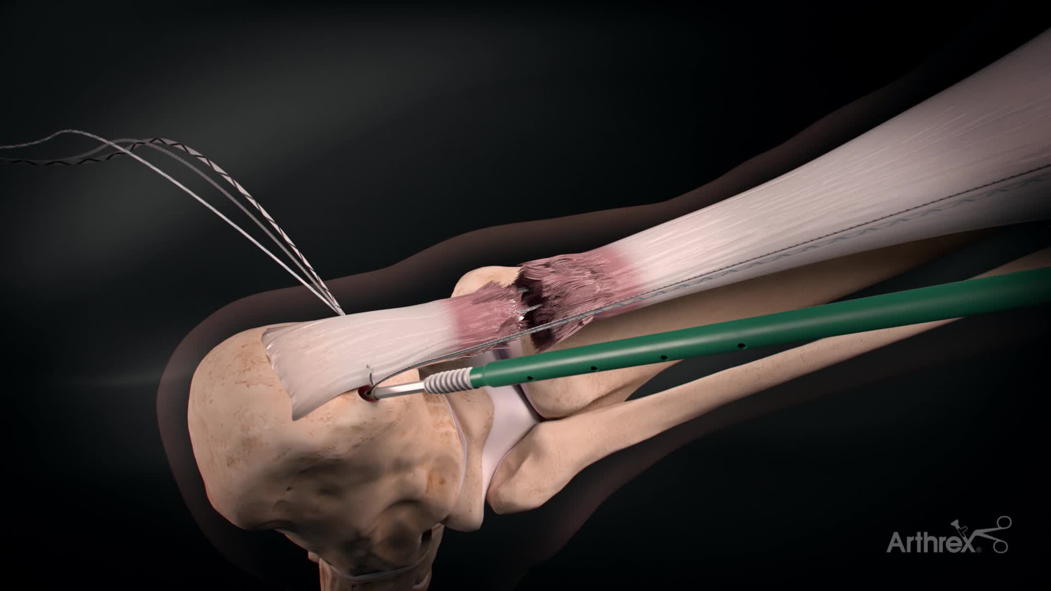 Arthrex - Achilles Midsubstance SpeedBridge™ Implant System