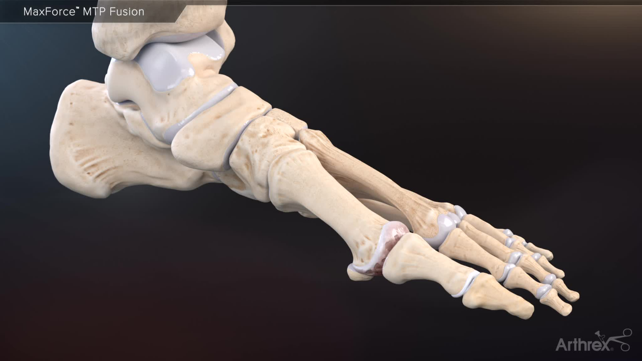 Arthrex - MaxForce™ MTP Plates
