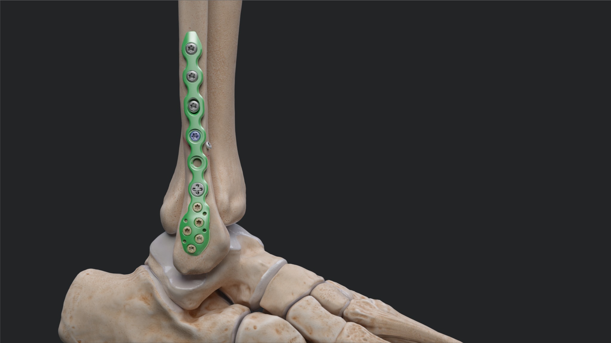 Arthrex - Titanium Locking Distal Fibula Plate