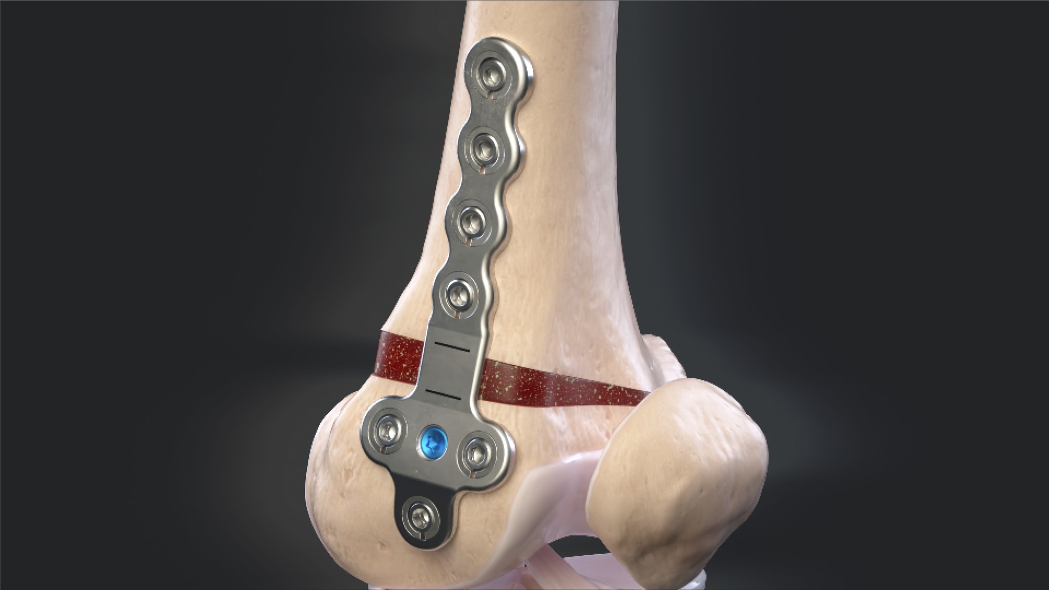 Arthrex - ContourLock™ Distal Femoral Osteotomy (DFO) Plates and Screws