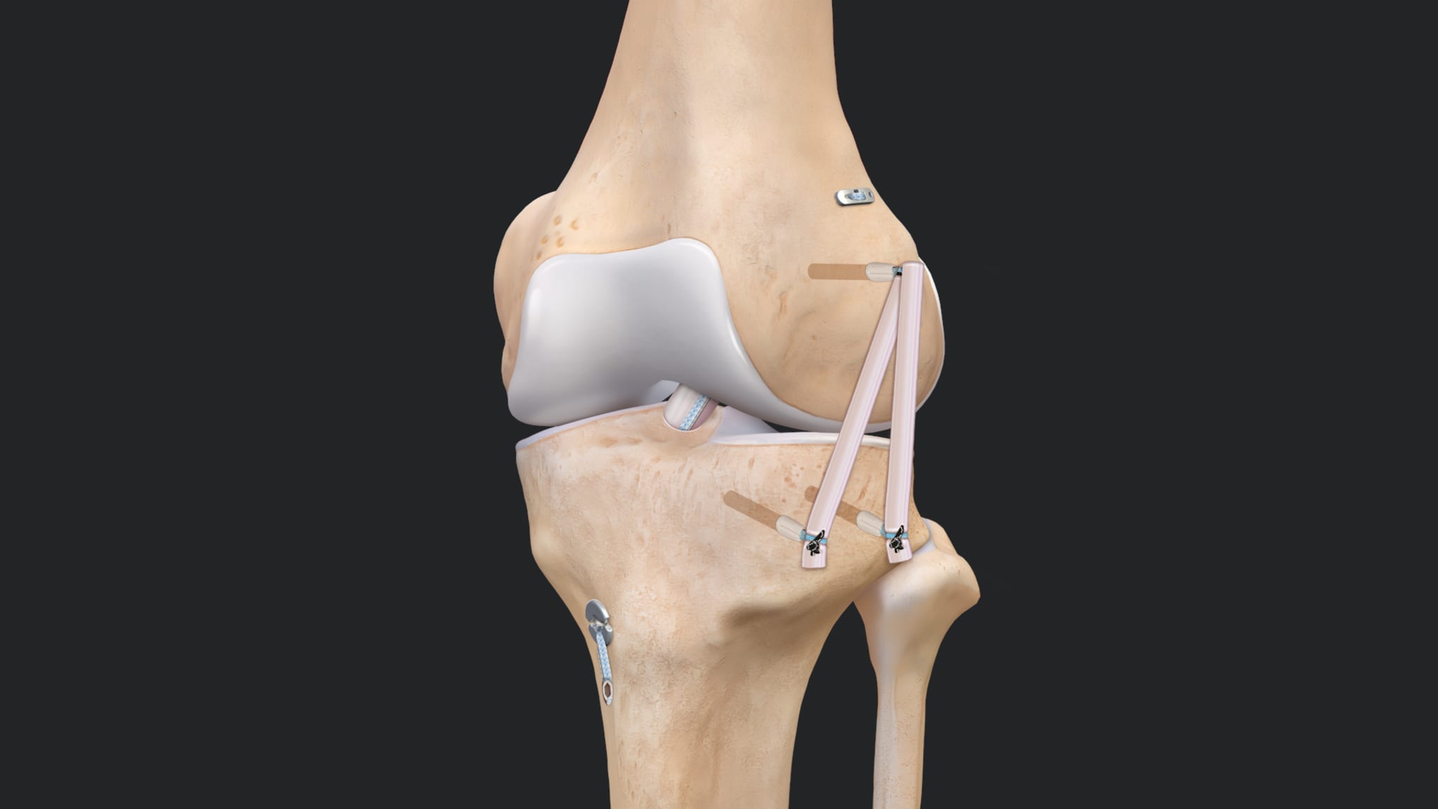 Arthrex - Iliotibial Band Tenodesis