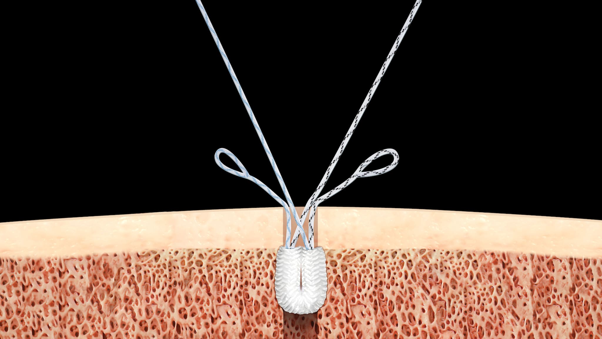 Arthrex - Patellar Tendon Repair