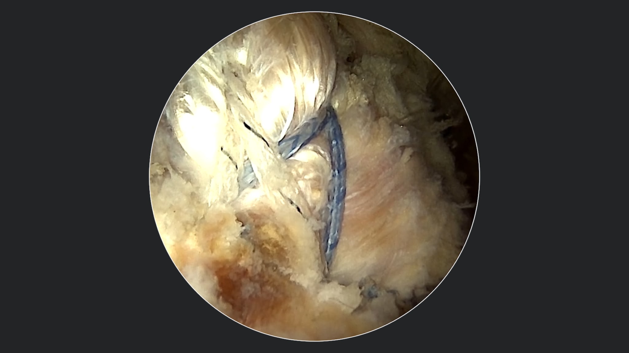 Repair Of Proximal Hamstring Tears: A Surgical Technique – CYCF
