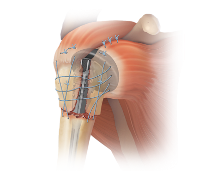 Arthrex - Total Shoulder Arthroplasty