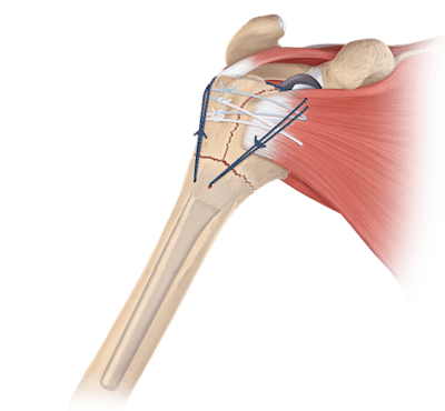 Arthrex - FxBridge™ Tuberosity Repair System: Reverse Total Shoulder ...