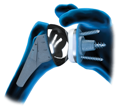 Arthrex - Total Shoulder Arthroplasty (TSA) Subscapularis Repair Using ...