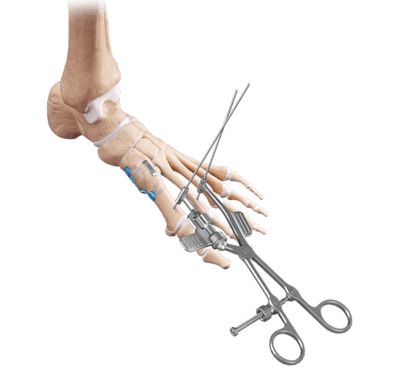 Arthrex - Hallux Valgus