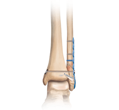 Arthrex - Ankle Fracture ORIF Utilizing the Syndesmosis TightRope® Fixation