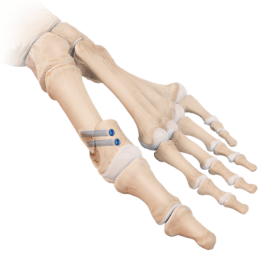 Arthrex - Arthrex Minimally Invasive Bunionectomy System Surgical Technique