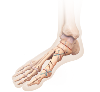 Arthrex - MIS Surgery Bunion Correction
