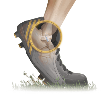 Arthrex - Lateral Ankle Instability