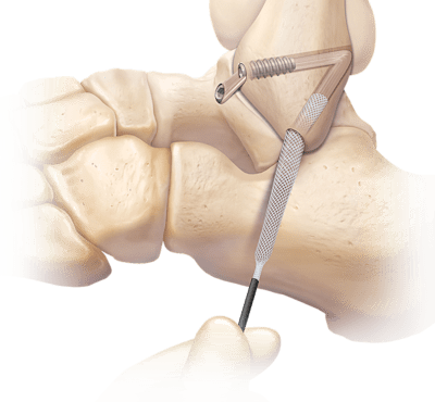 Arthrex - Lateral Ankle Instability