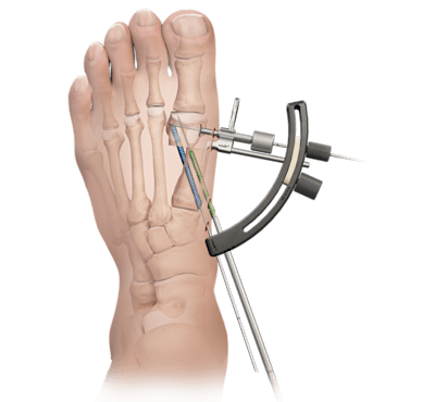 Arthrex - Arthrex Minimally Invasive Bunionectomy System Surgical Technique