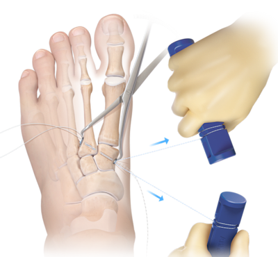 Arthrex - Knotless Mini TightRope Implant System, 2.7 mm, Titanium - AR ...