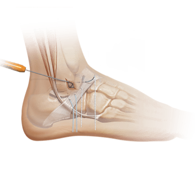 Arthrex - Suture Anchor, BioComposite SutureTak, Small Joint with one ...