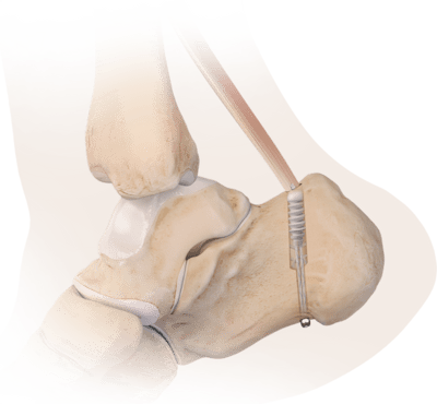 Arthrex - Soft Tissue Fixation Devices