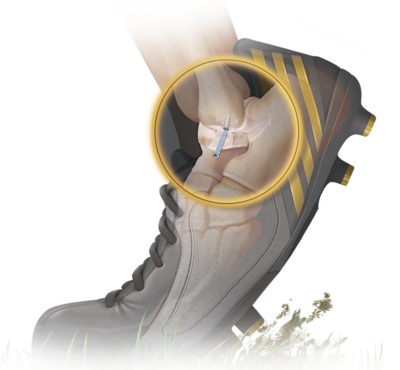 Arthrex - Superior Peroneal Retinaculum (SPR) Repair With InternalBrace ...